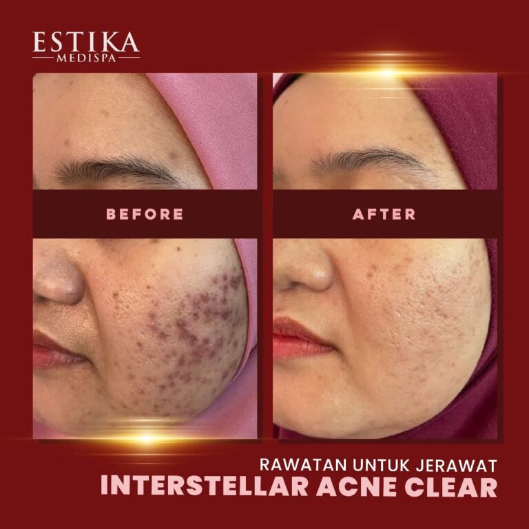 Top 7 Cara Hilangkan Jerawat Muka (Proven Berkesan!)